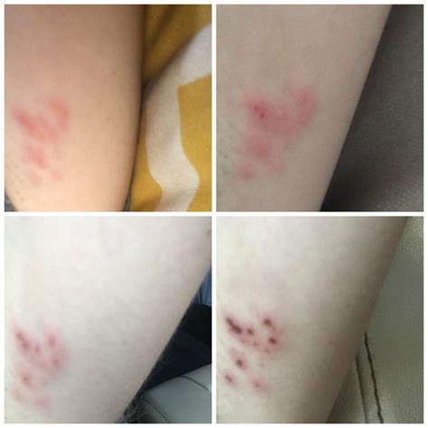 Shingles Stages