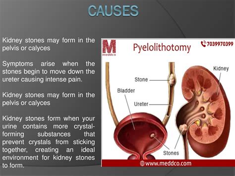 Ppt Pyelolithotomy Surgery Powerpoint Presentation Free Download