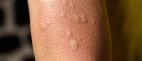 What Causes Hives When To Worry Upmc Healthbeat