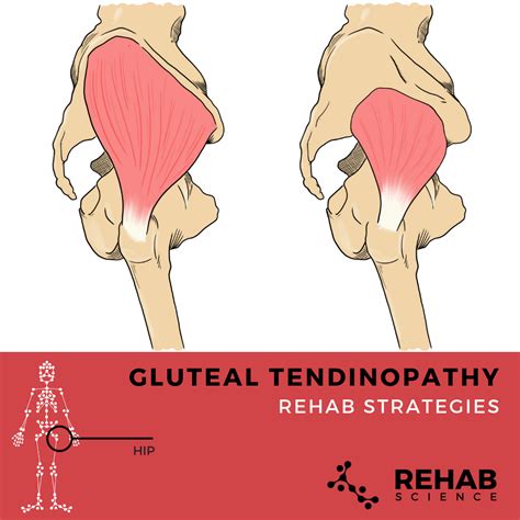 Gluteus Medius Minimus Syndrome