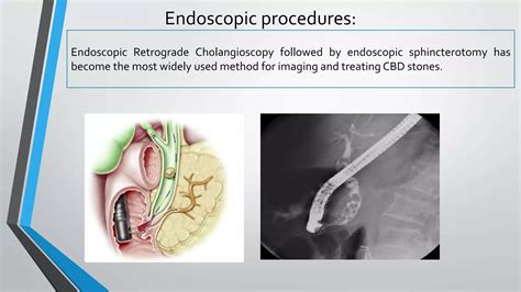 CBD Stones Choledocholithiais Biliary Stones PPTX