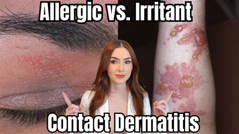 Irritant Vs Allergic Contact Dermatitis How To Tell The Difference