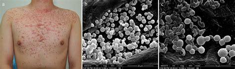 Observation Of Fungi Bacteria And Parasites In Clinical Skin Samples