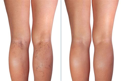 Tipos De Varices Cómo Tratarlas De Forma Eficaz