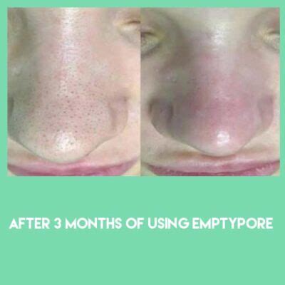 Emptypore™ Sebaceous Filament Removal Machine Clevive