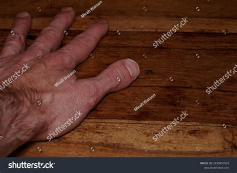 Brachydactyly Type D 8 Images Photos Et Images Vectorielles De Stock