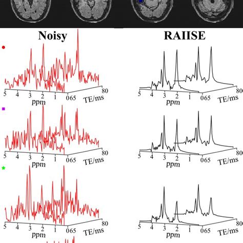 1 H Mrsi Results From A Pte Patient The Top Panel Shows The Anatomical