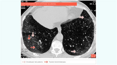 Ground Glass Opacity Elementary Lesions Imaging Atlas