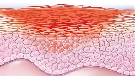 Atopy Etiology Lessons Learnderm