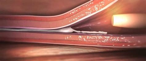 Venaseal Canada Vein Clinics
