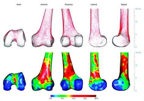 Three Dimensional 3d Spatial Distribution Of Distal Femoral Fracture