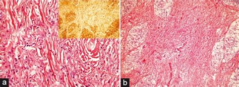 Bilateral Symmetrical Zygomatic Mass Pmc