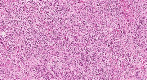 Carcinosarcoma Of The Uterus Ottawa Atlas Of Pathology