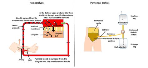 Peritoneal Dialysis Vs Hemodialysis