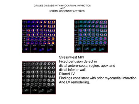 Ppt Stress Rest Mpi Fixed Perfusion Defect In Distal Antero Septal