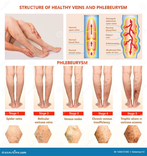 Thrombophlebitis Medicine 3d Illustration Stock Image