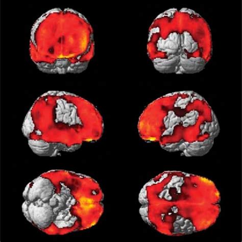 Visualization Of The Results Of Statistical Parametric Mapping Download Scientific Diagram