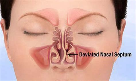 How To Cure A Deviated Septum Treatmentstop21