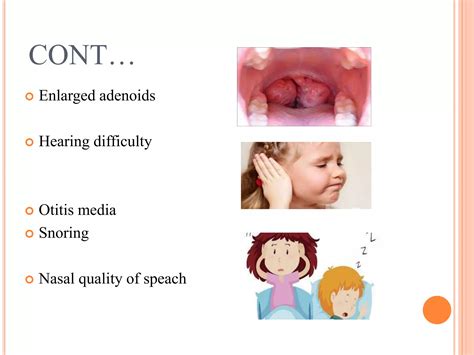 Tonsilitis Ppt 1 Pptx