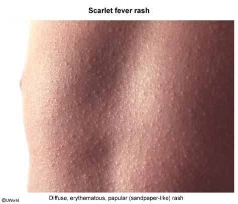 Scarlet Fever Dermatology Uworld Medical Library