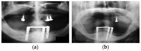 Anterior Hyperfunction By Mandibular Anterior Teeth A Narrative Review