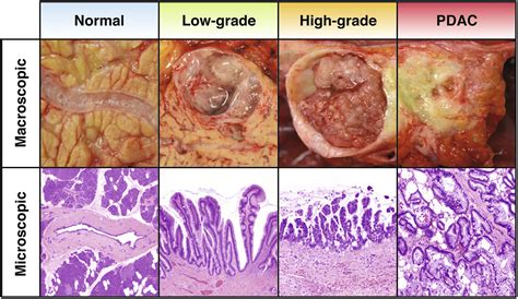 Early Detection Of Pancreatic Cancer Opportunities And Challenges