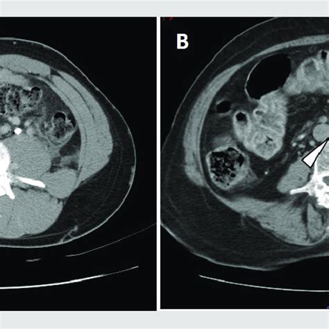 A Ivc Agenesis Of The Infrarenal Segment Ct Scan The Ivc Is