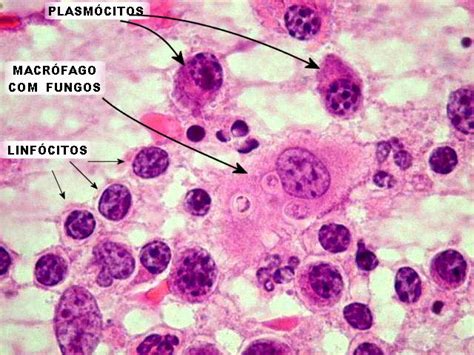 Paracoccidioidomicose E Histoplasmose Estomatologia Online