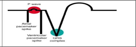 Pacemaker Flashcards Quizlet