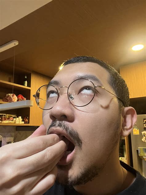 Gssspotted ข่าวดี แผลหายปรกติดี ยังมีอาการบวม