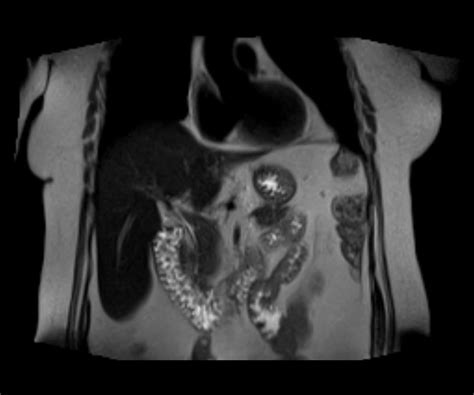 How To Interpret Abdominal Mris 3 Essential Techniques