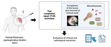 Supraspinatus Tendon Tear Treatment