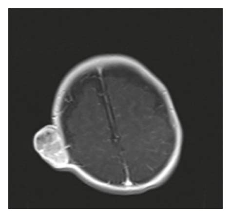 Contrast Enhanced CT Demonstrating Right Parietal Vividly Enhancing Download Scientific Diagram