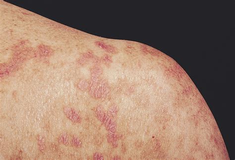 Lichenoid Dermatitis Treatment Ljprrc