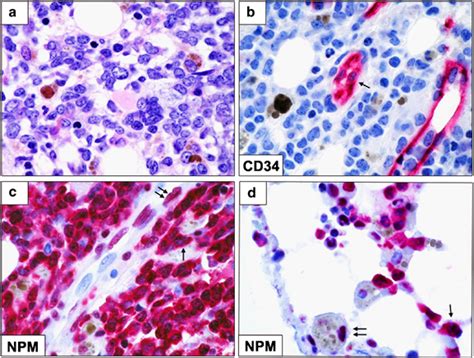 Bone Marrow At First Relapse Of Aml Acute Myeloid Leukaemia Download Scientific Diagram