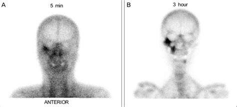 The Triphasic Bone Scan 99m Tc A During Blood Pool Phase There Download Scientific