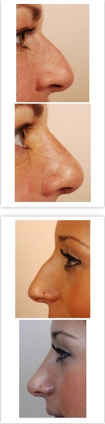 Nose Job Cost Buildmyhealth Nose Job Rhinoplasty Cost Nose Job Cost