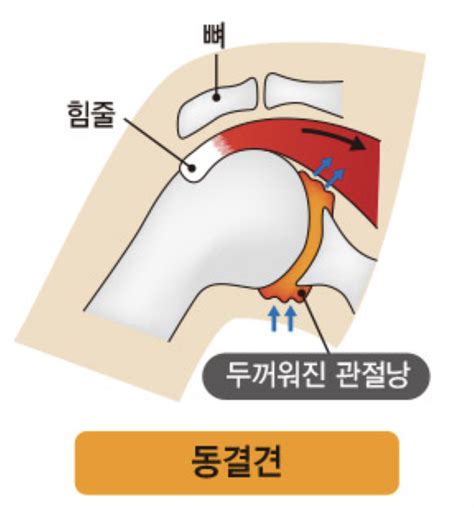 오십견 3단계 증상 및 원인과 치료 방법 바로팁스