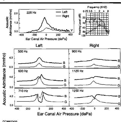 Otosclerosis Tympanogram