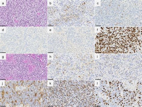 Plag1 Fusions Extend The Spectrum Of Plag L Altered Cns Tumors Pmc