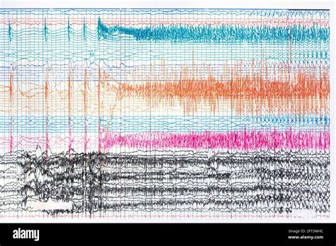 Photograph Of Ictal Eeg Recording During Seizure Seizure Waves Showing