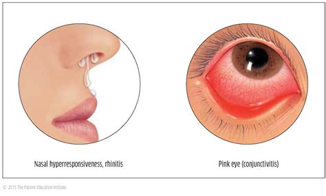 Allergic Rhinoconjunctivitis And Exploring The Causes Of Chronic