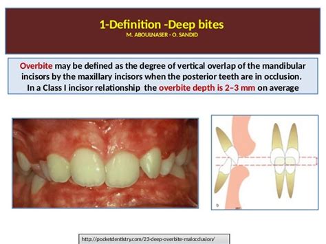 Deep Bite Malocclusions M Aboulnaser Orthodontist Bua Usa O San