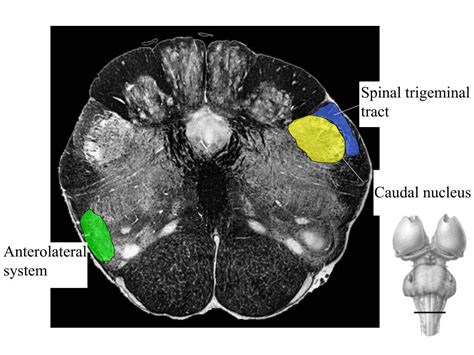 Ppt Trigeminal System Powerpoint Presentation Free Download Id 2999930