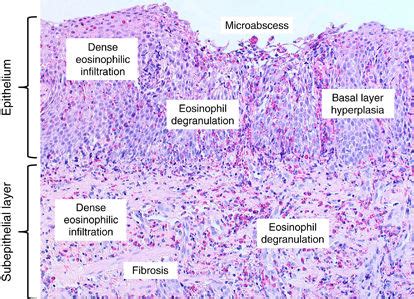 Eosinophilic Esophagitis Relationship Of Subepithelial Eosinophilic