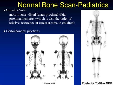 Bone Scan