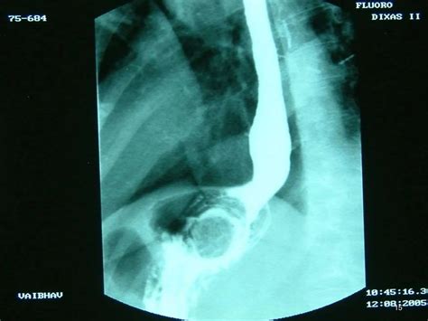 Gist Gastrointestinal Stromal Tumor Ppt Digestive Disorders Diseases And Conditions