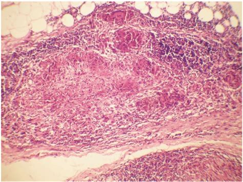 Delayed Type Hypersensitivity In Dermal Nerve Skin Bt In Type 1
