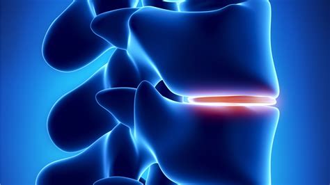 Herniated Disc Program At Cram Osteopaths Glasgow