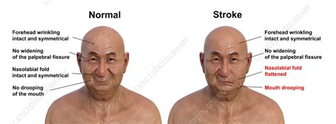 Left Side Stroke Illustration Stock Image F0436035 Science